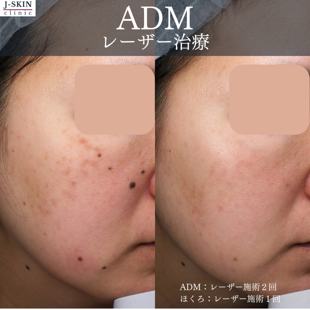 JSKINクリニックのシミ治療（総論） - JSKINクリニック東京銀座｜ほくろ・まぶた・肌の悩みに応える美容医療